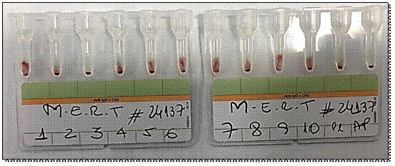 Anticuerpos anti-Chido/Rodgers en paciente con enfermedad infecciosa ...