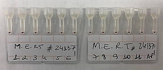 Anticuerpos anti-Chido/Rodgers en paciente con enfermedad infecciosa ...