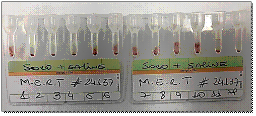 Anticuerpos anti-Chido/Rodgers en paciente con enfermedad infecciosa ...