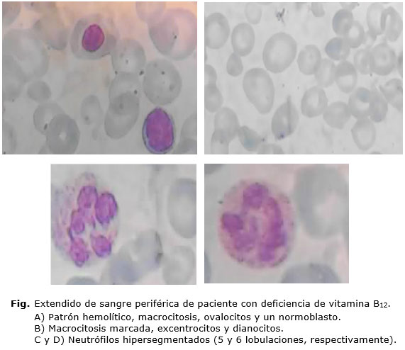 Trastornos neurológicos graves en lactante con anemia megaloblástica ...